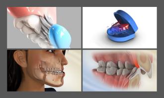 ORTHO2 BLOG | Edge Animations: Animated Patient Education